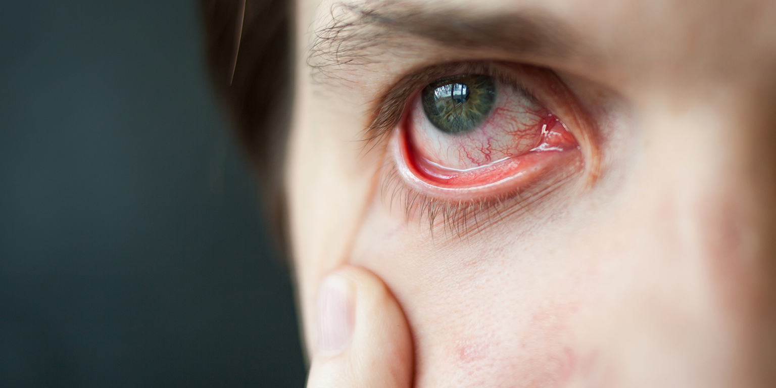 Mens red eye close-up, fatigue, problems with blood vessels | Simovision